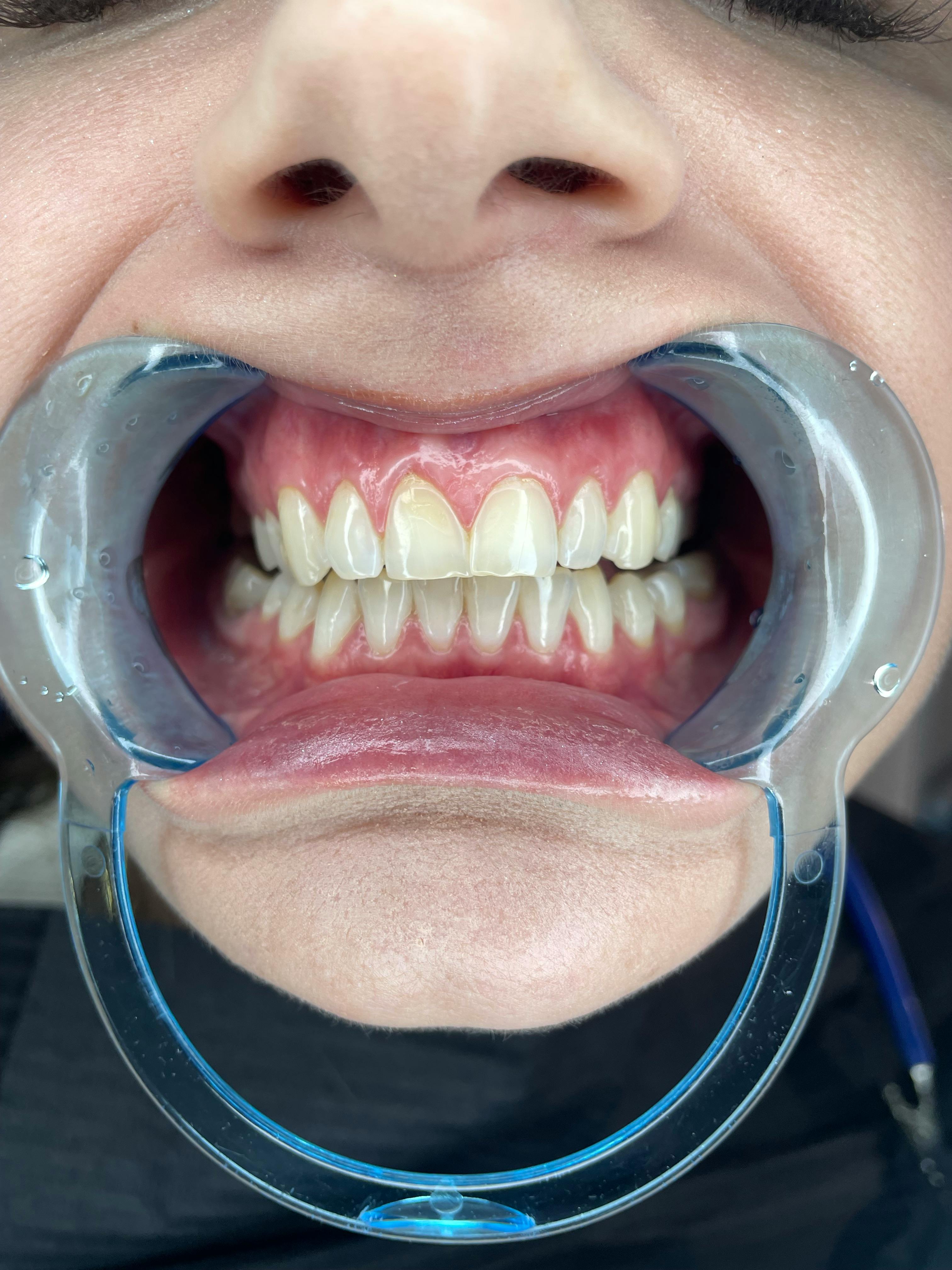 Foto de stock gratuita sobre alineación de los dientes, anatomía de la ...
