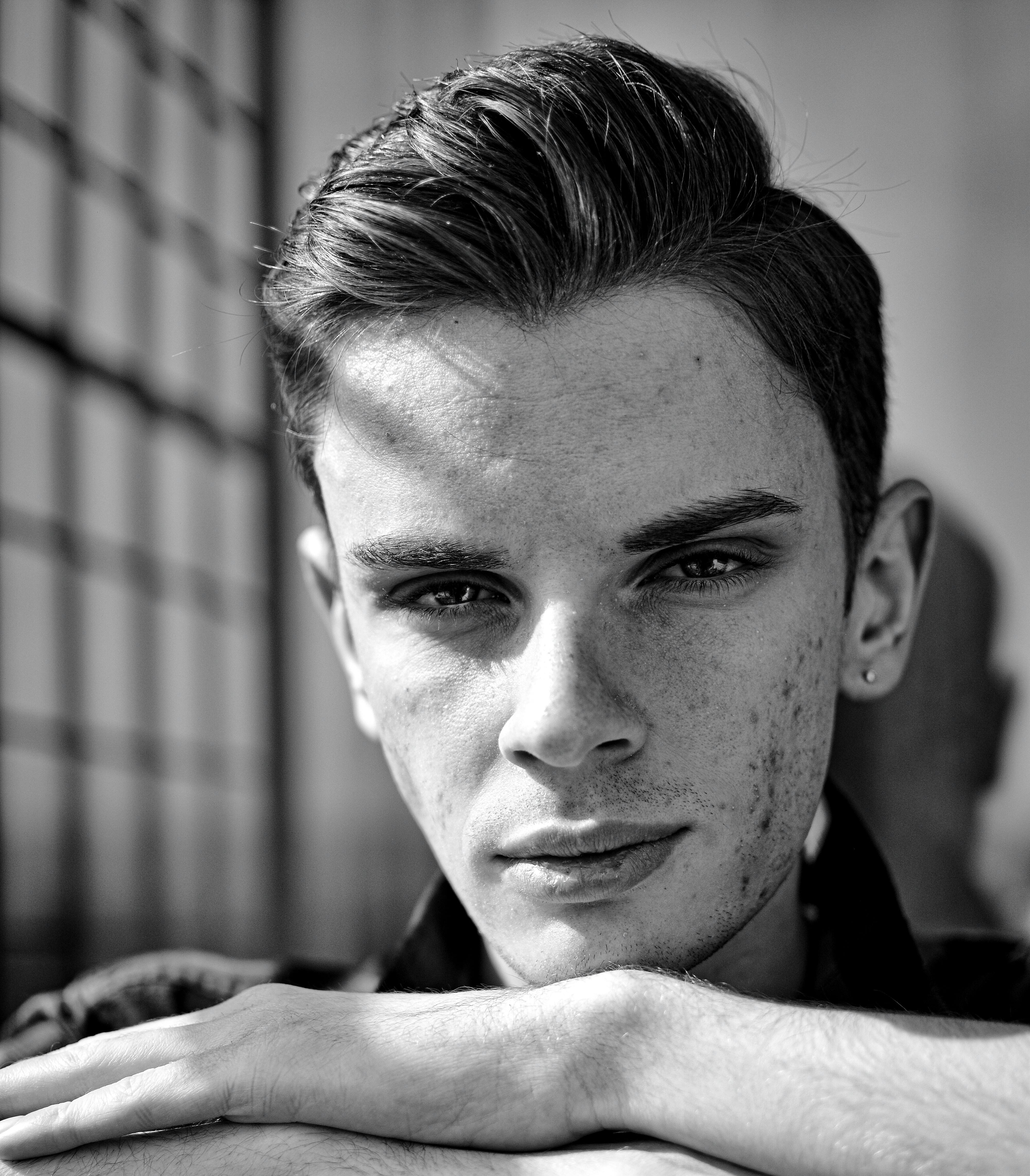 Model With Acne Photos, Download The BEST Free Model With Acne Stock ...