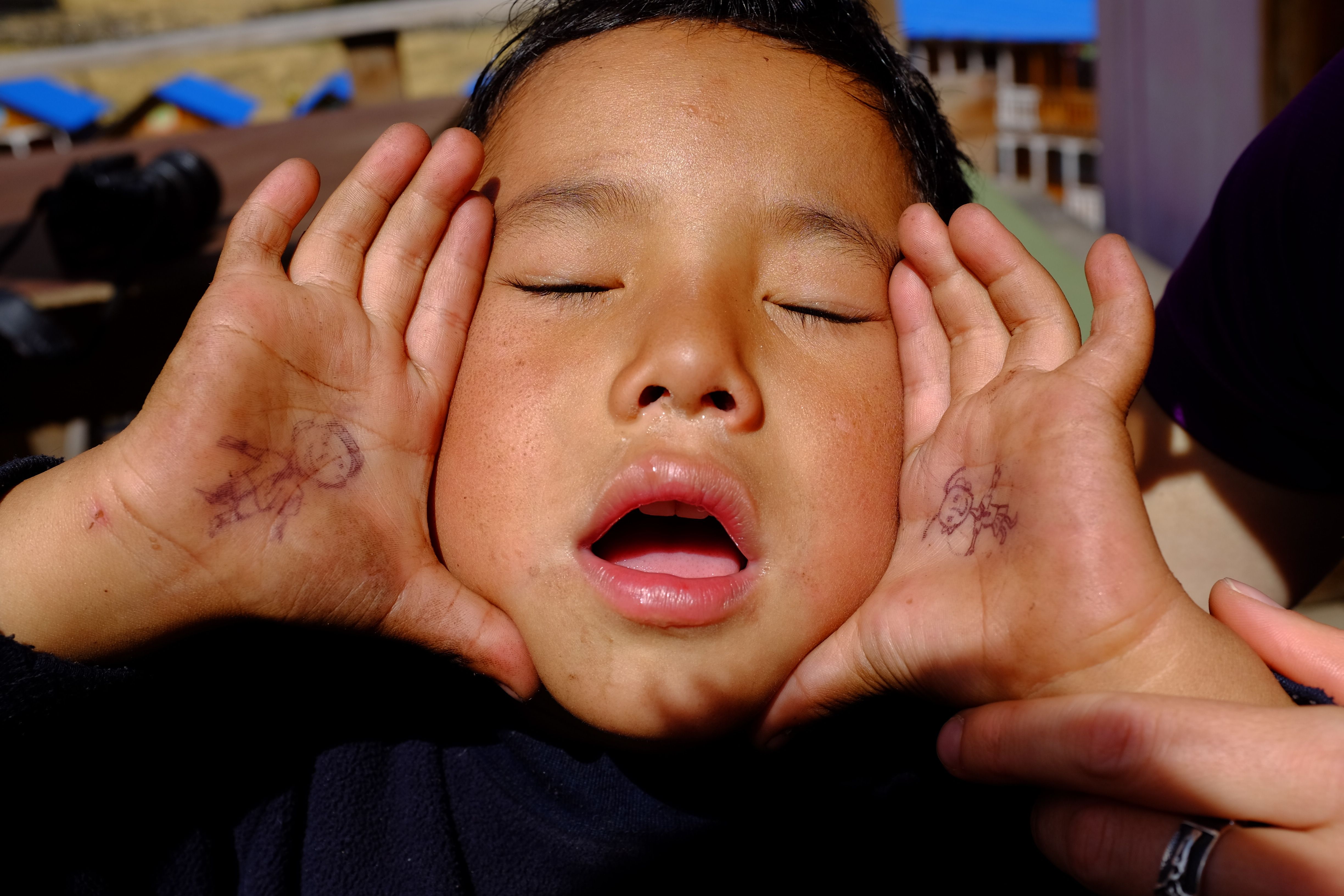 Pimples Face Boy Photos, Download The BEST Free Pimples Face Boy Stock ...