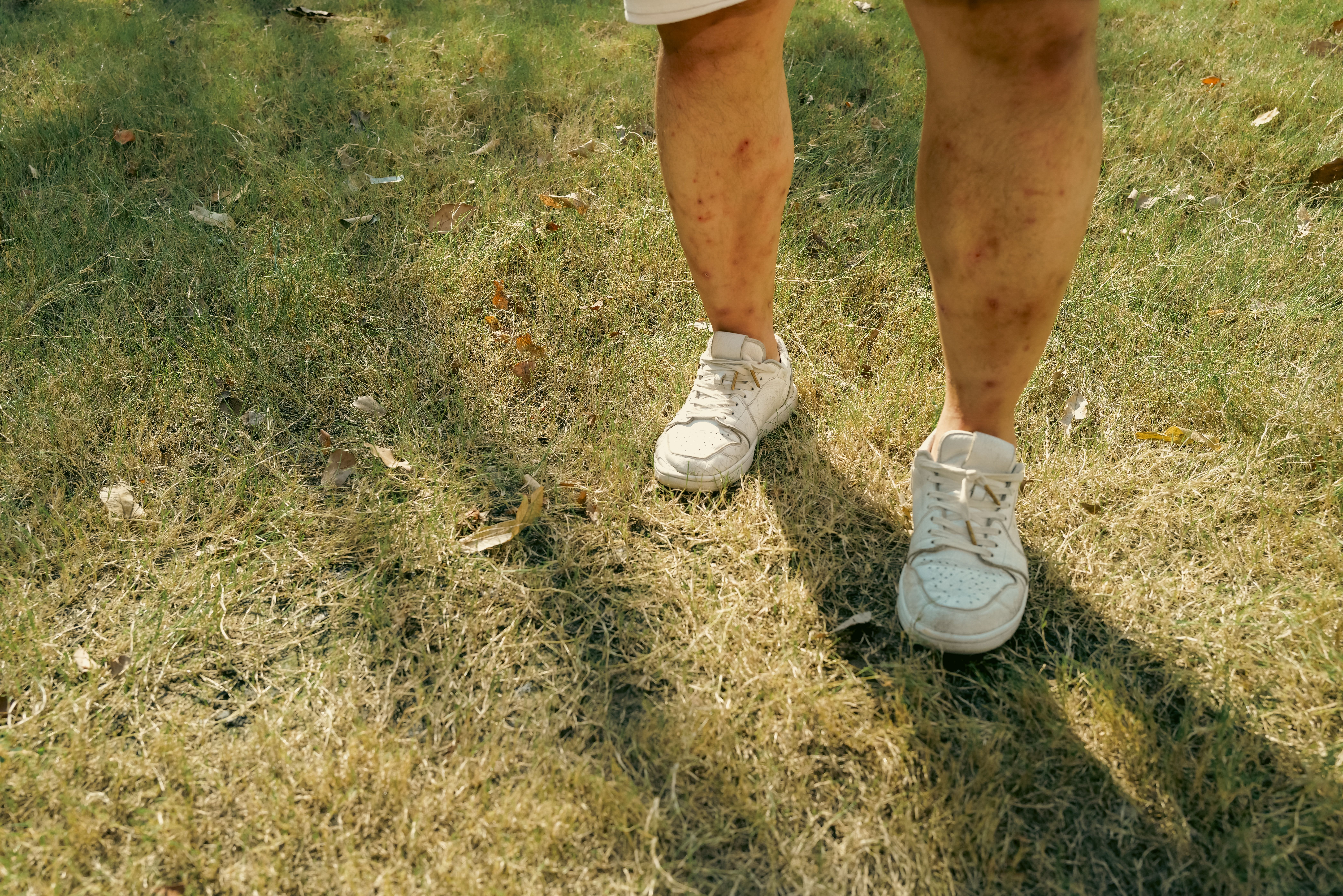 Person walking on grass with leg scars visible · Free Stock Photo