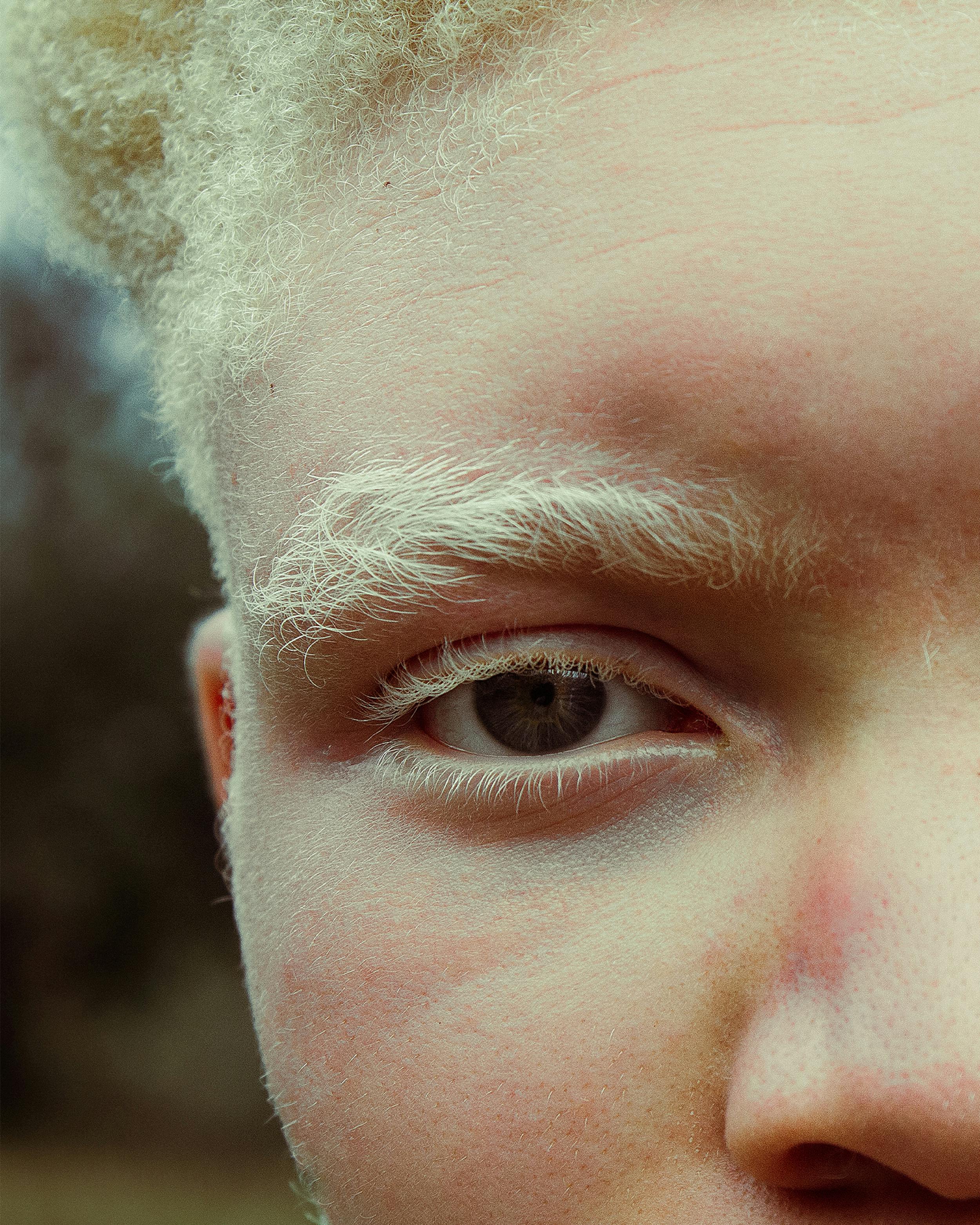 Close-up Portrait of Person with Albinism Outdoors · Free Stock Photo