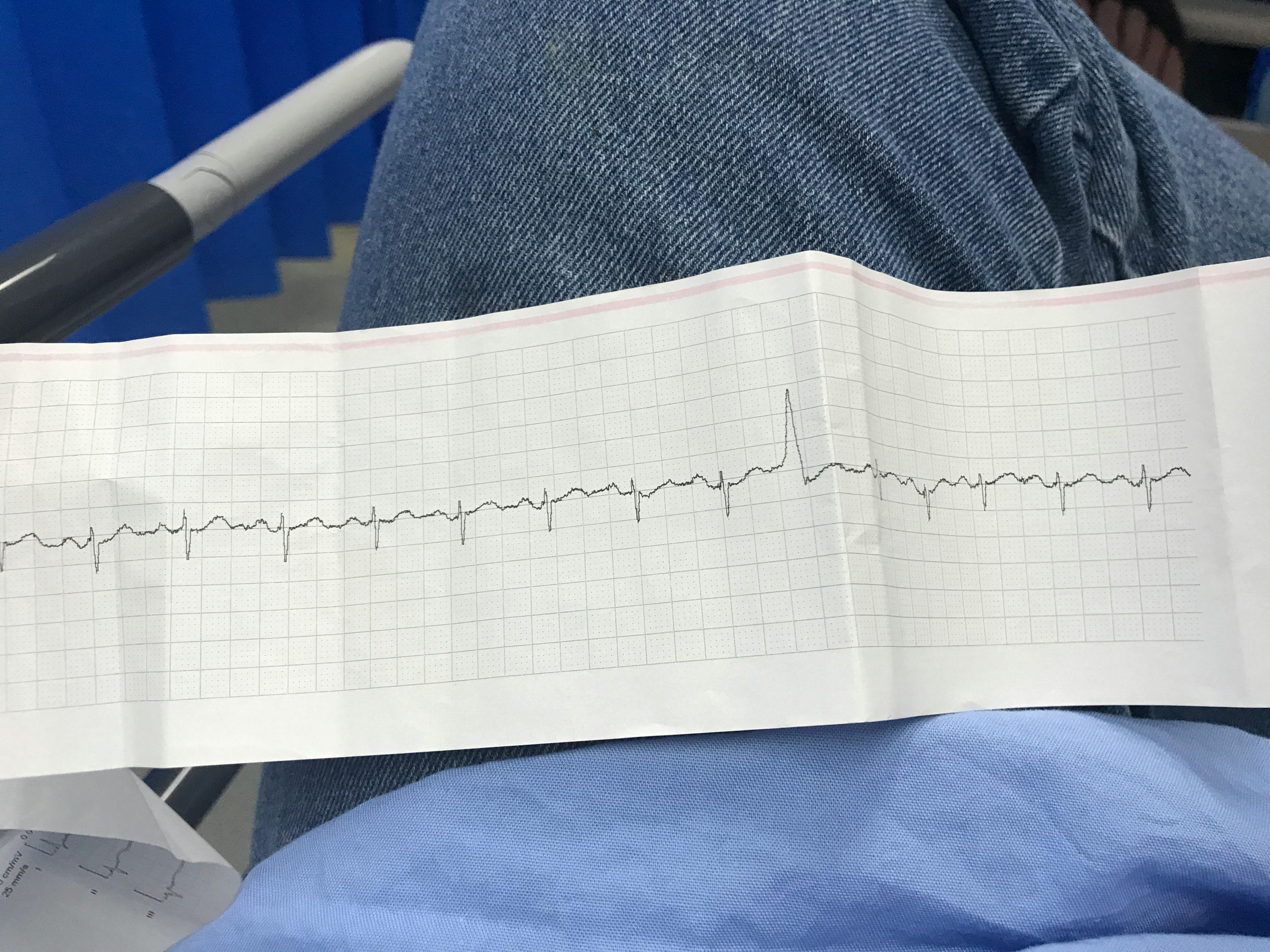Free stock photo of arrhythmia, cardiac, ecg