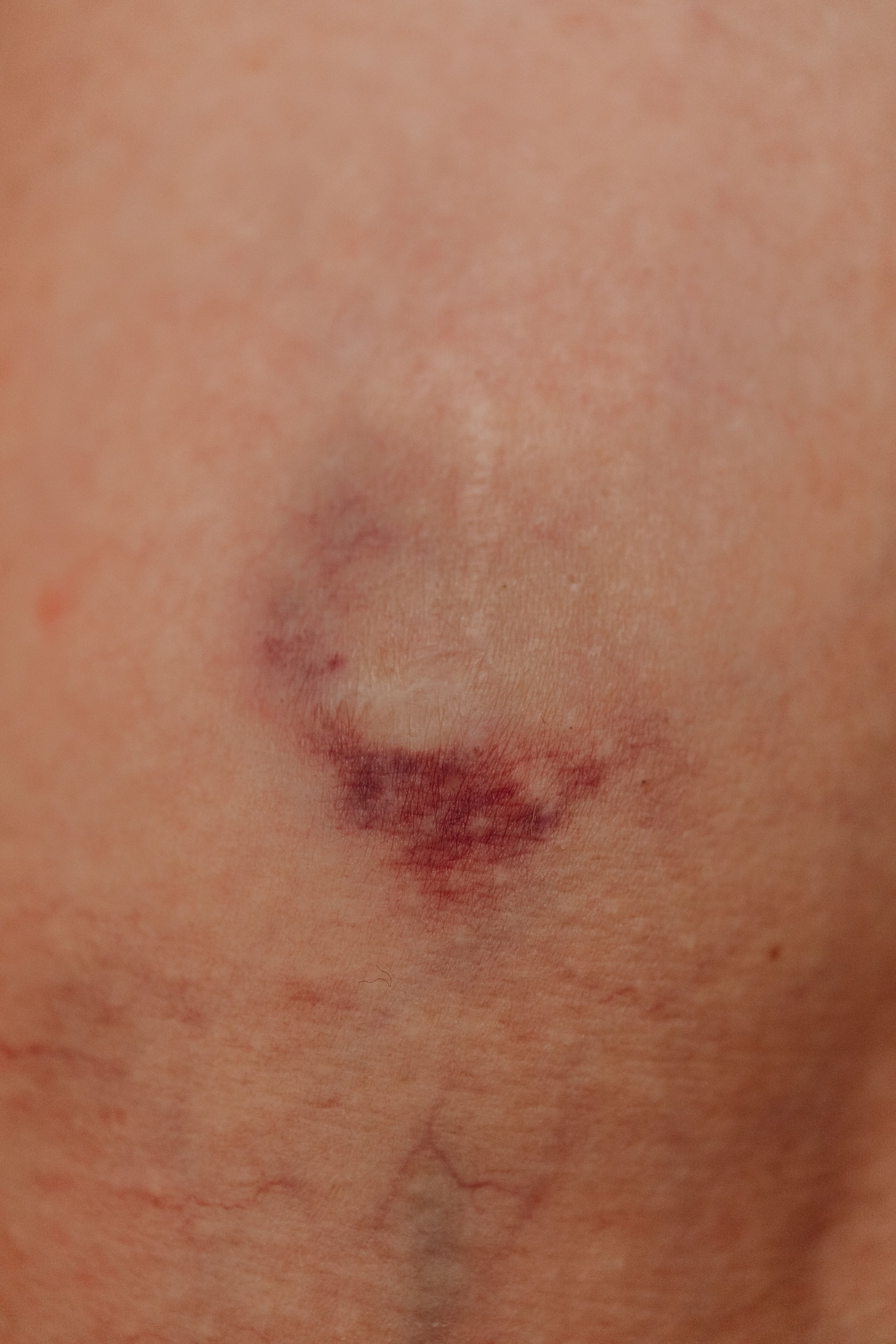 Close-up of Bruises on Human Body · Free Stock Photo