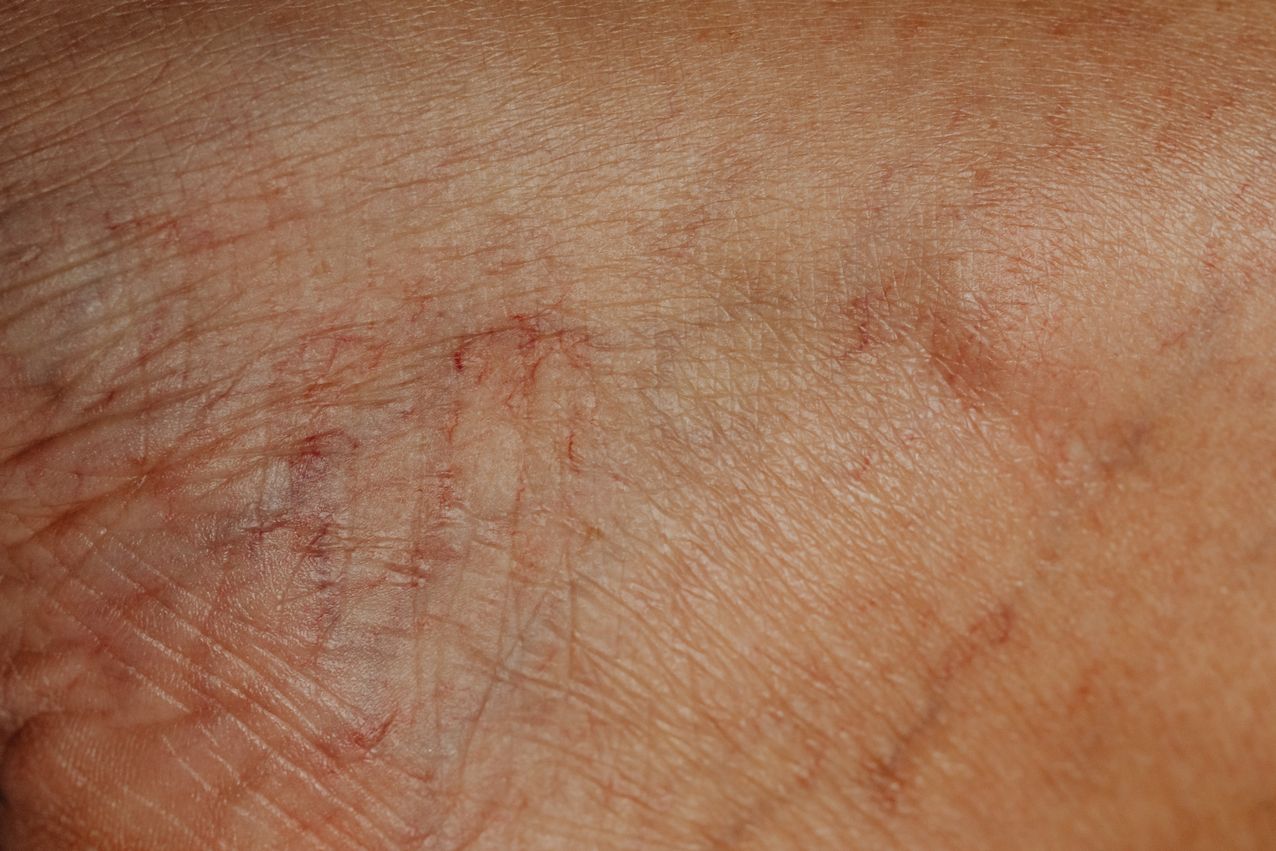 Understanding Cutaneous Hemangiosarcoma in Dogs - A Guide
