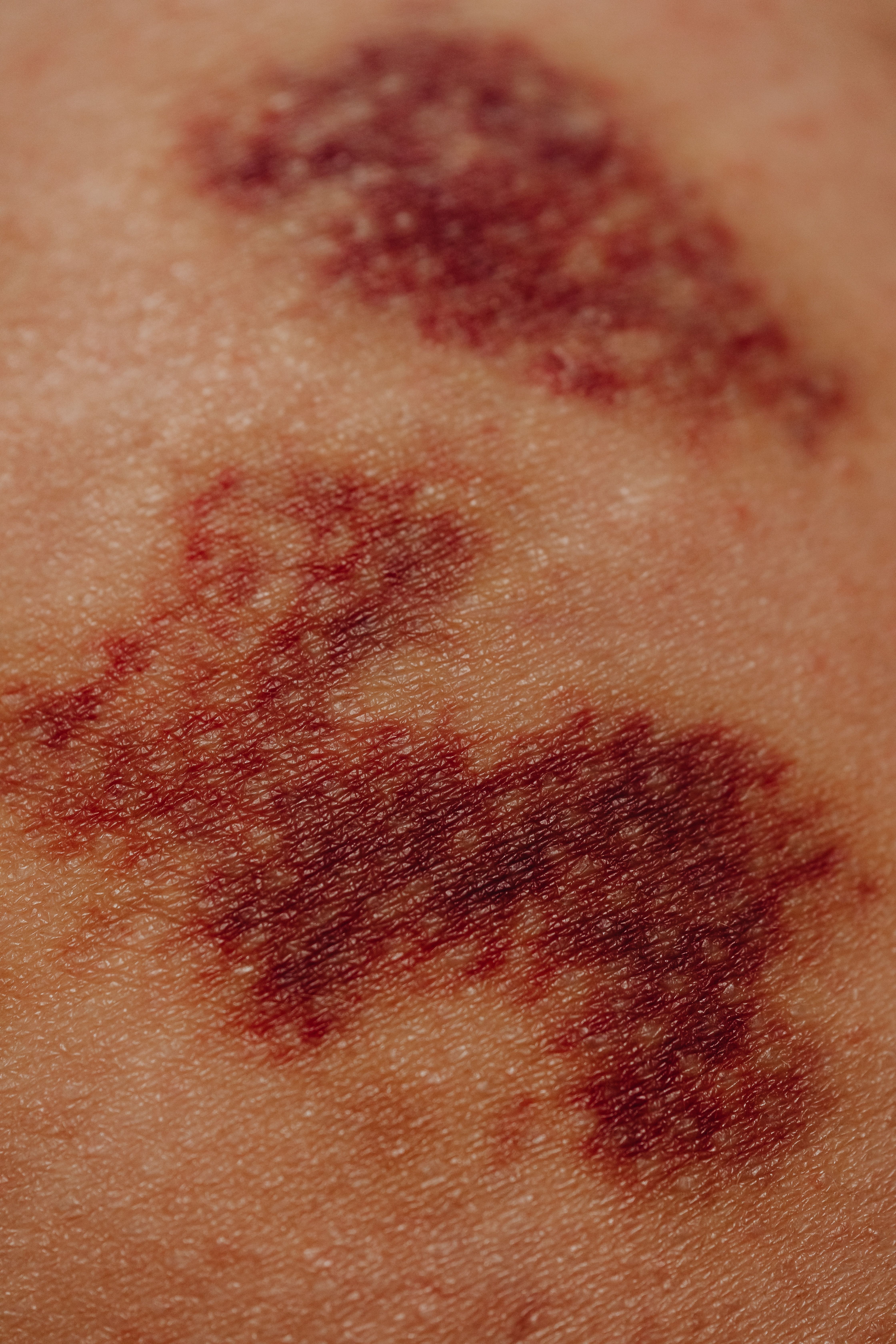 Bruises Photos, Download The BEST Free Bruises Stock Photos & HD Images