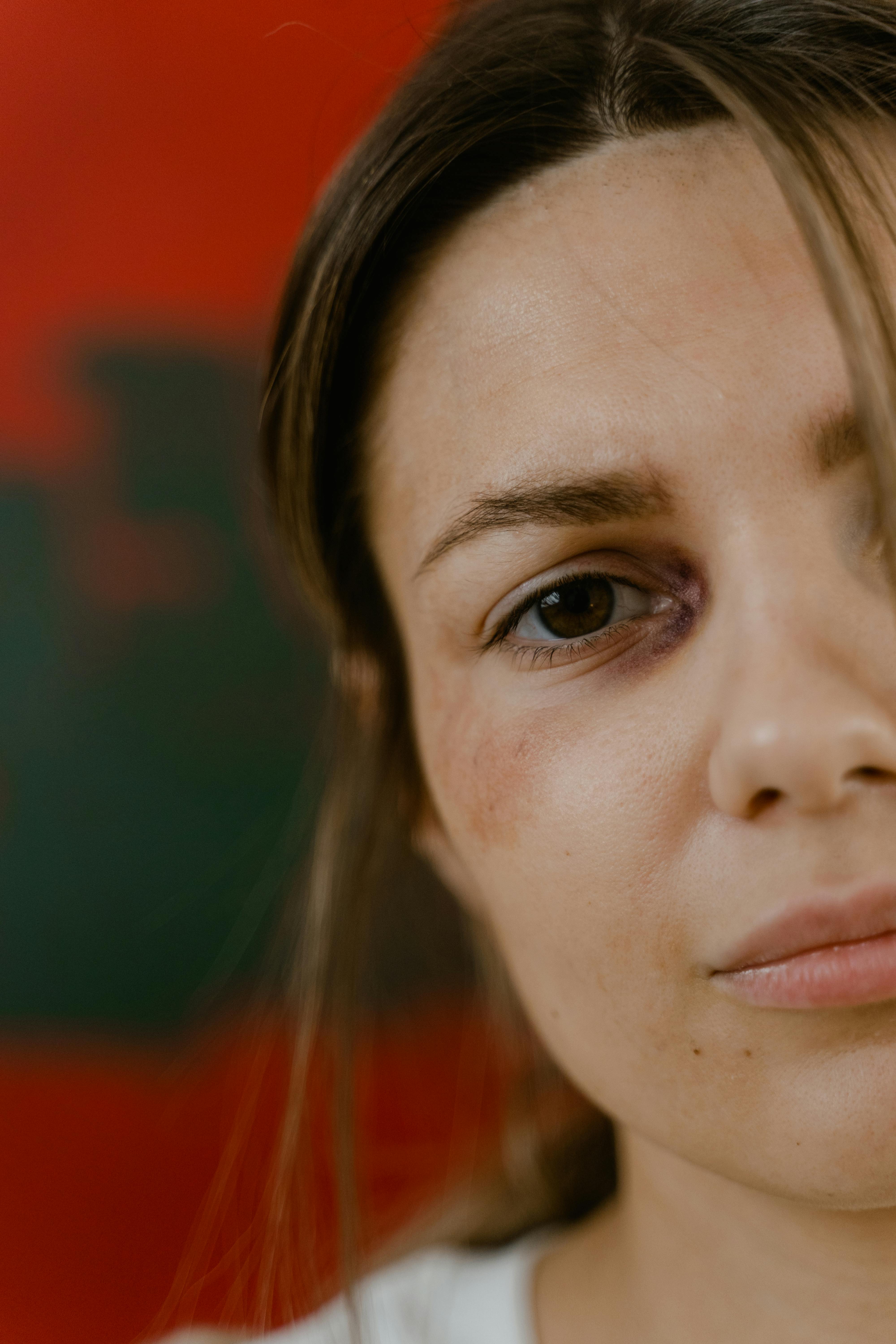 Black Eye Photos, Download The BEST Free Black Eye Stock Photos & HD Images