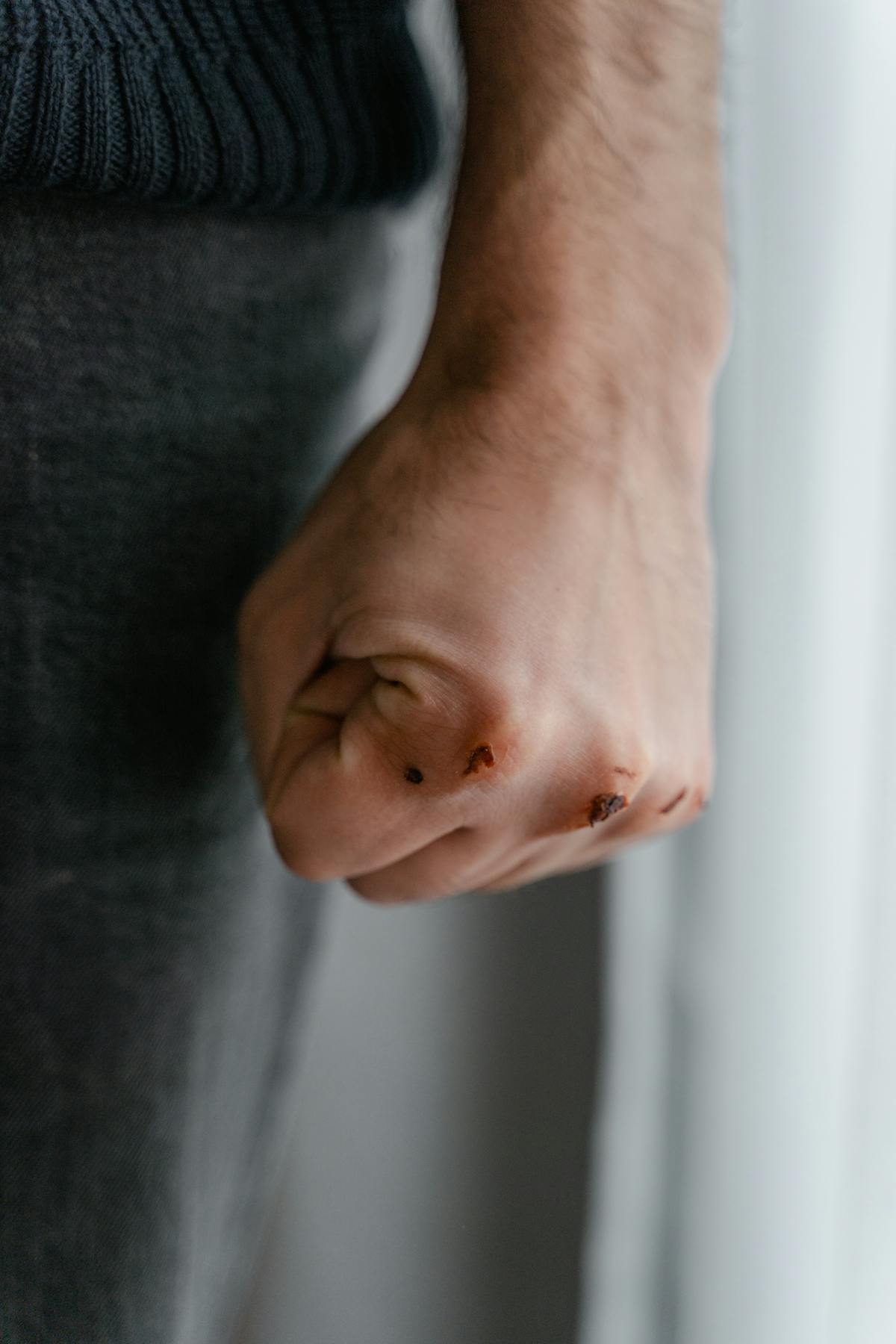 Bruise Photos, Download The BEST Free Bruise Stock Photos & HD Images