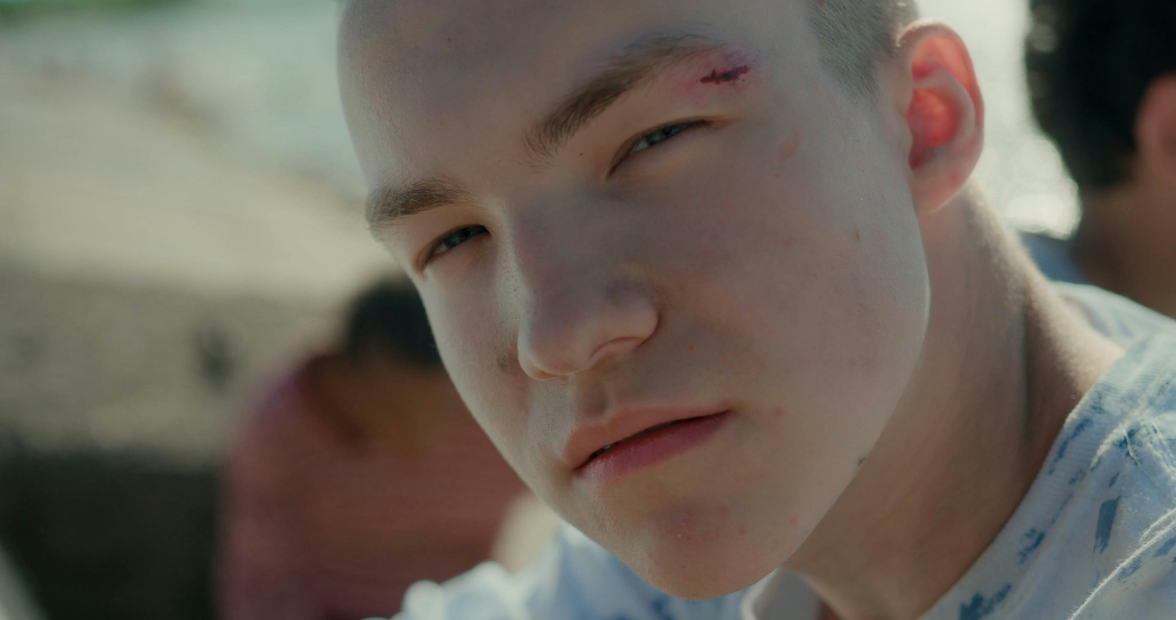 Bruises Videos, Download The BEST Free 4k Stock Video Footage & Bruises ...