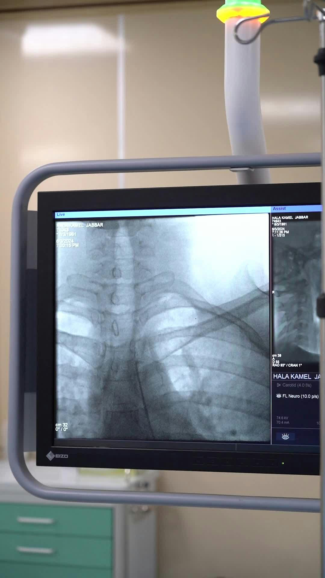 Cvc Catheter Videos, Download The BEST Free 4k Stock Video Footage ...