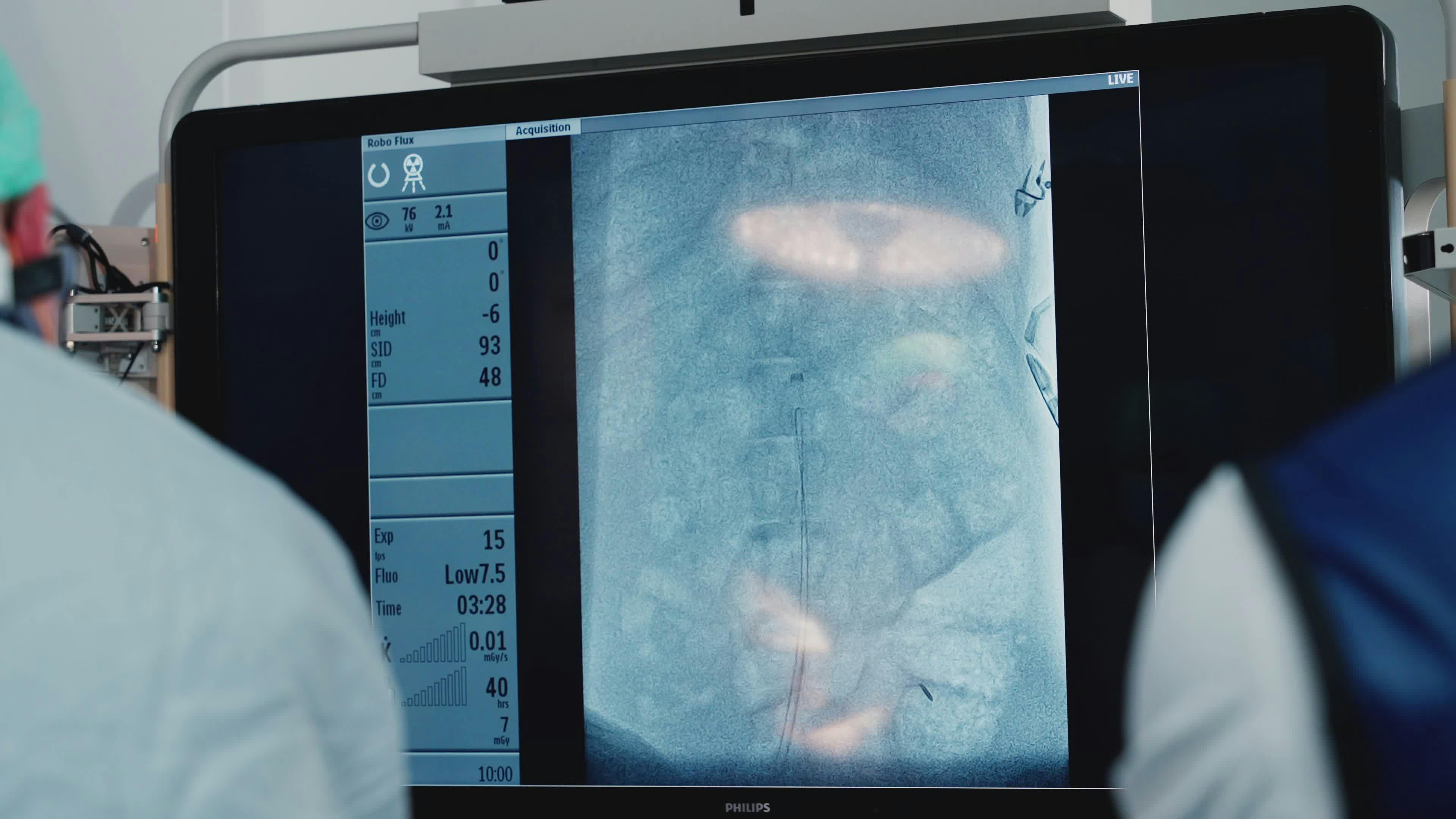 Real-time Surgical Procedure Monitoring Display Free Stock Video ...