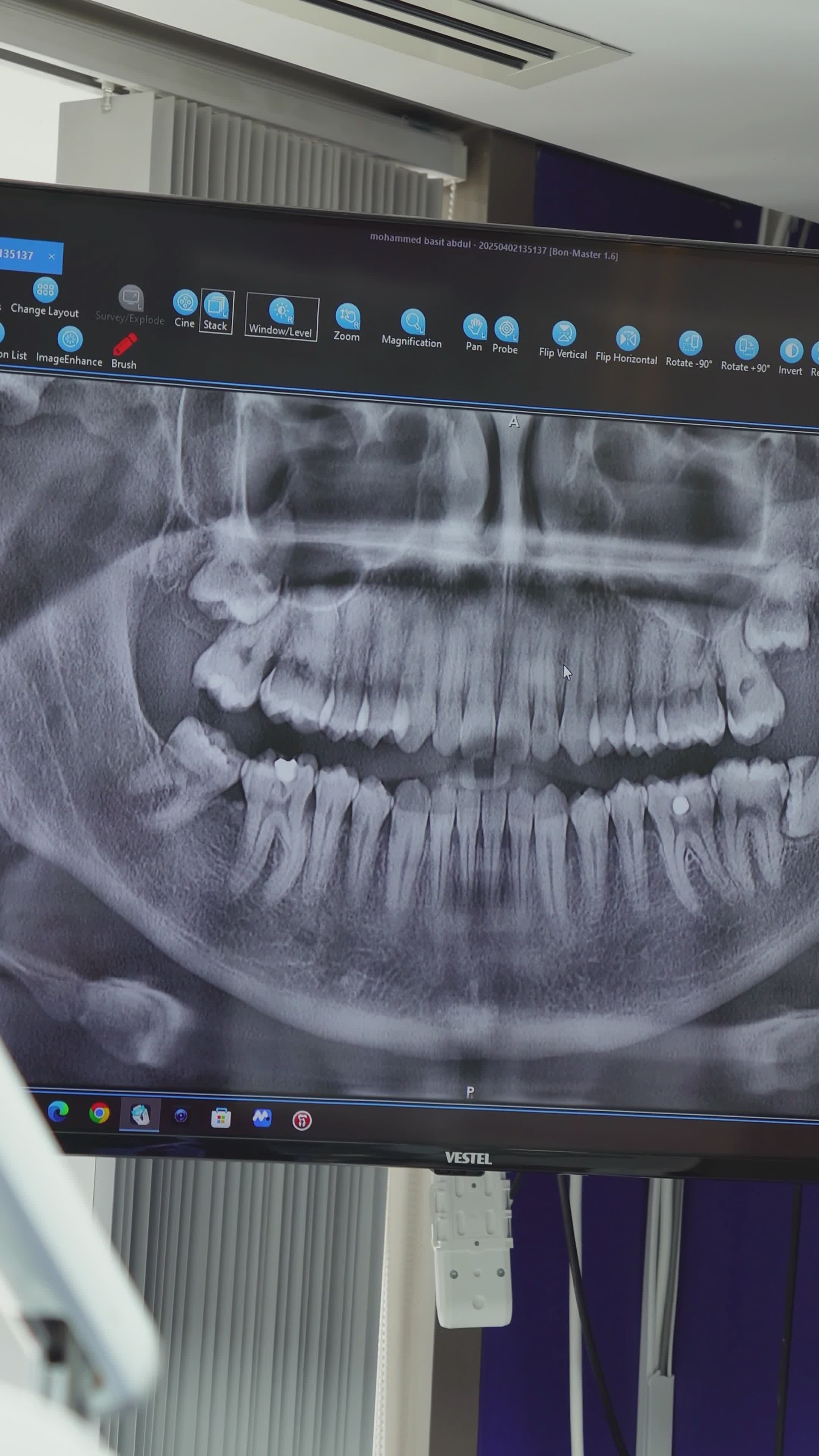 High-Resolution Dental X-Ray Display in Clinic Free Stock Video Footage ...