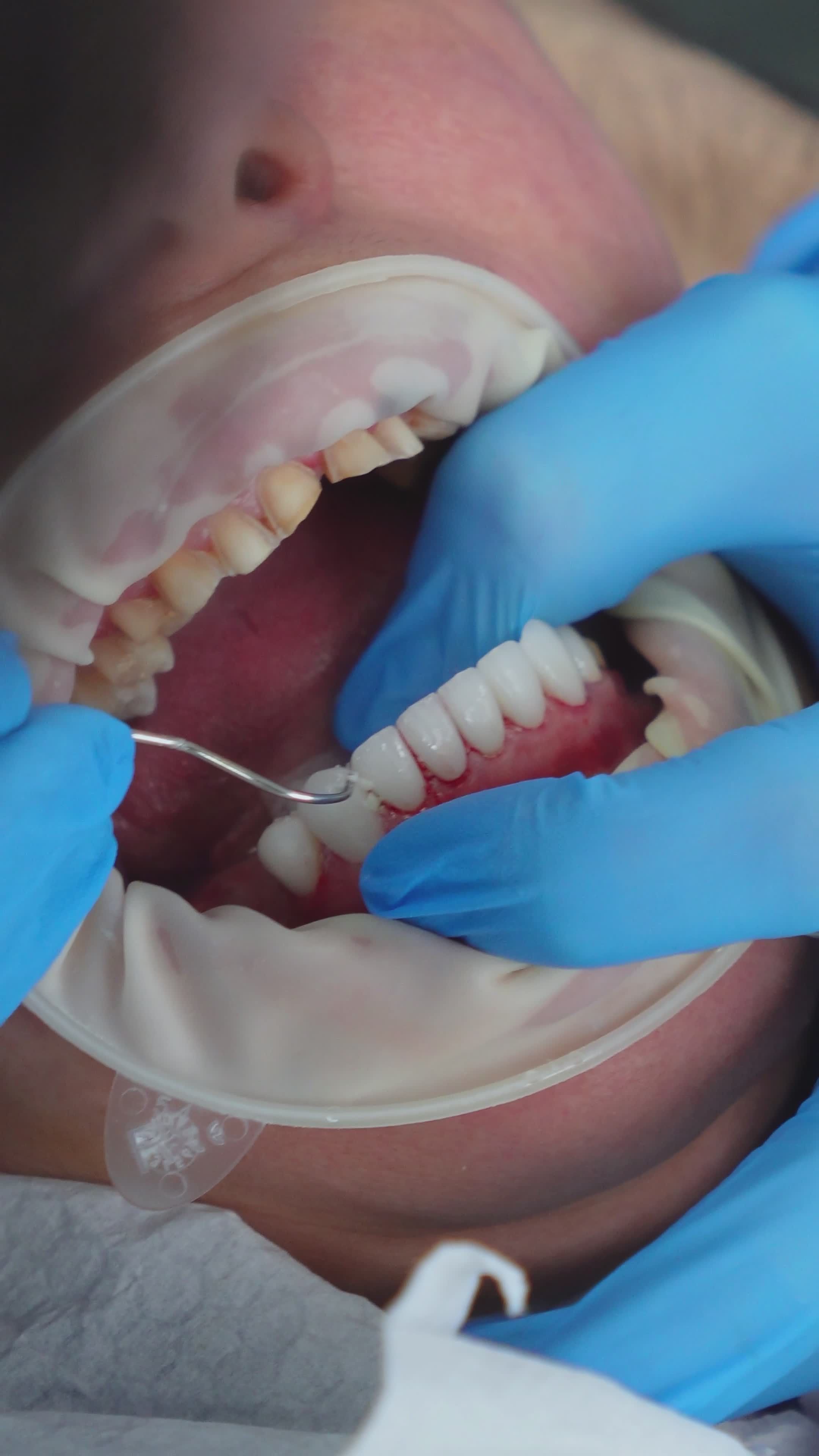 Close-up Dental Cleaning Procedure in Clinic Free Stock Video Footage ...