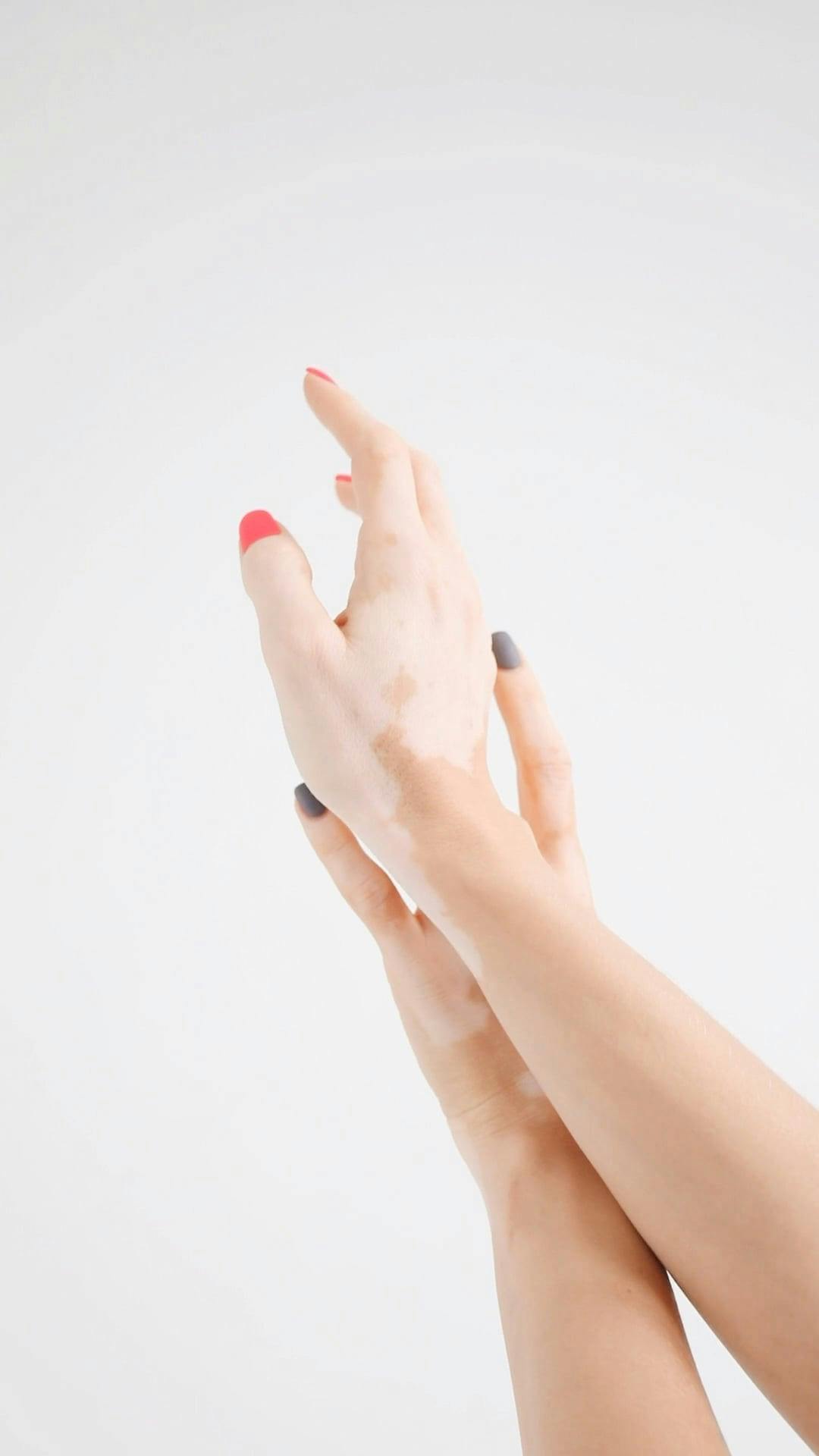 A Woman Having Skin Discoloration On Her Hands Free Stock Video Footage ...