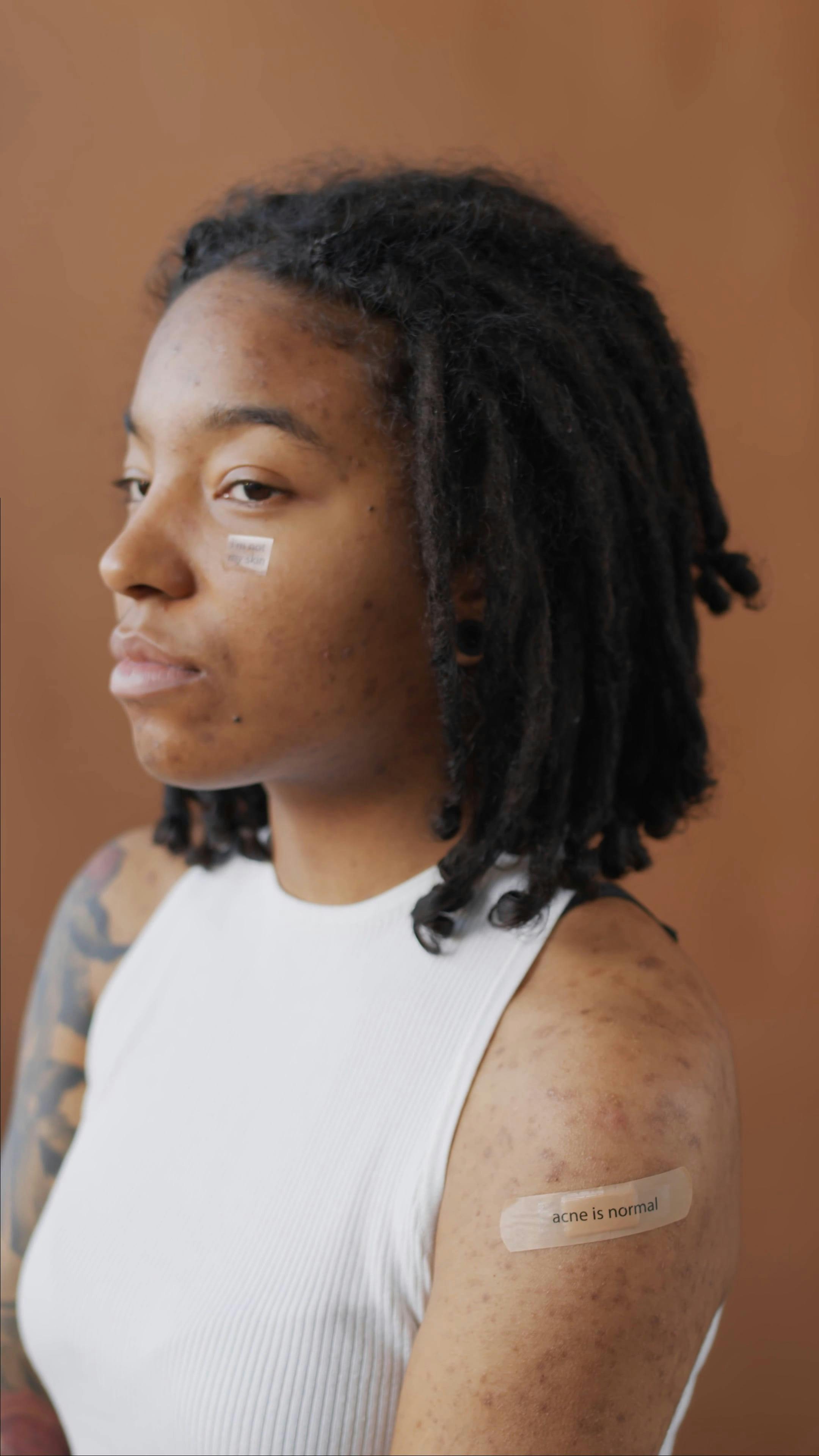 Woman's Face With Acne Free Stock Video Footage, Royalty-Free 4K & HD ...