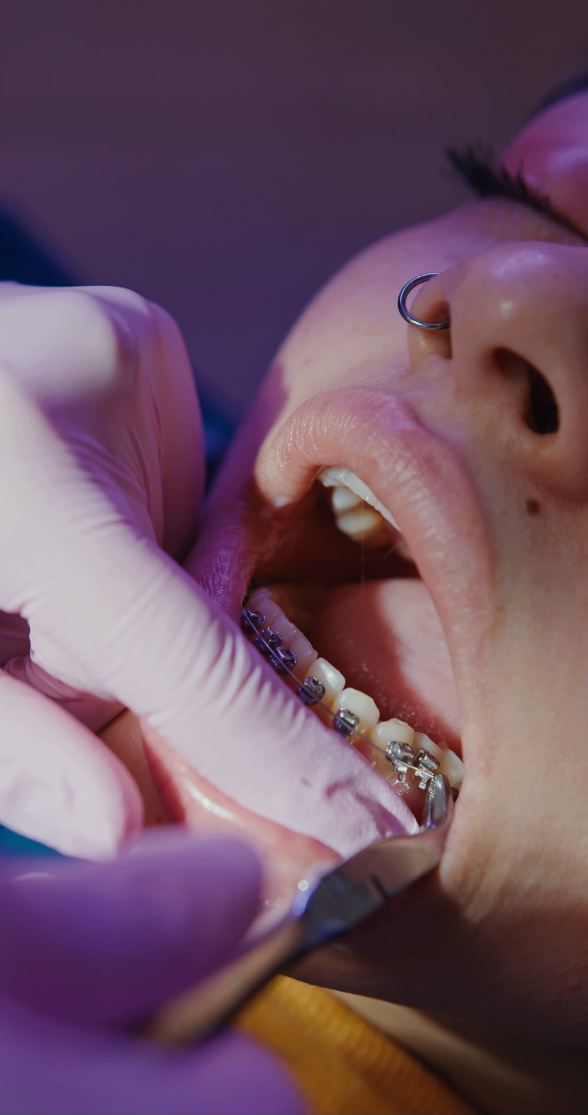 Braces Videos, Download The BEST Free 4k Stock Video Footage & Braces ...