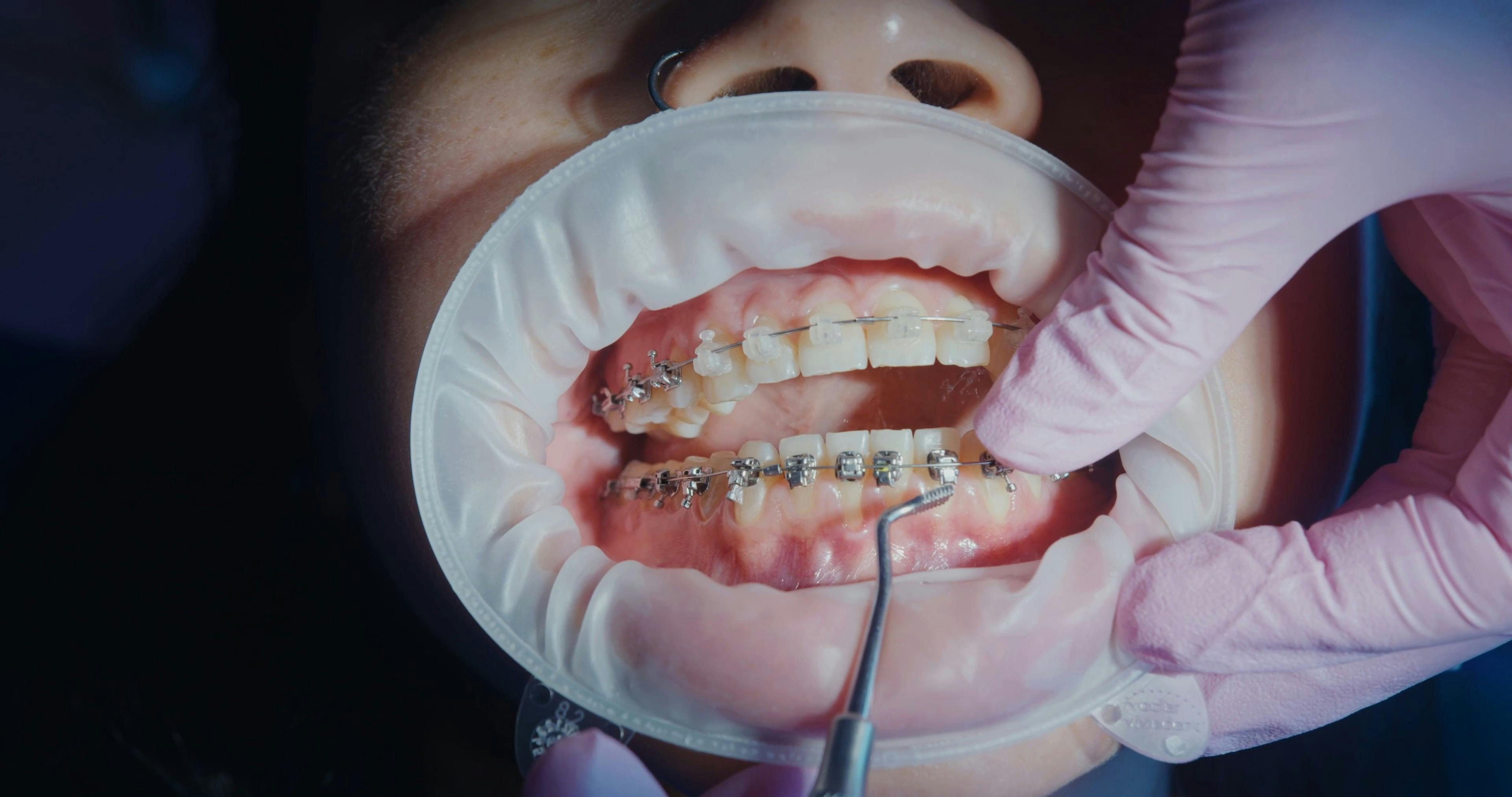 Clear Teeth Videos, Download The BEST Free 4k Stock Video Footage ...