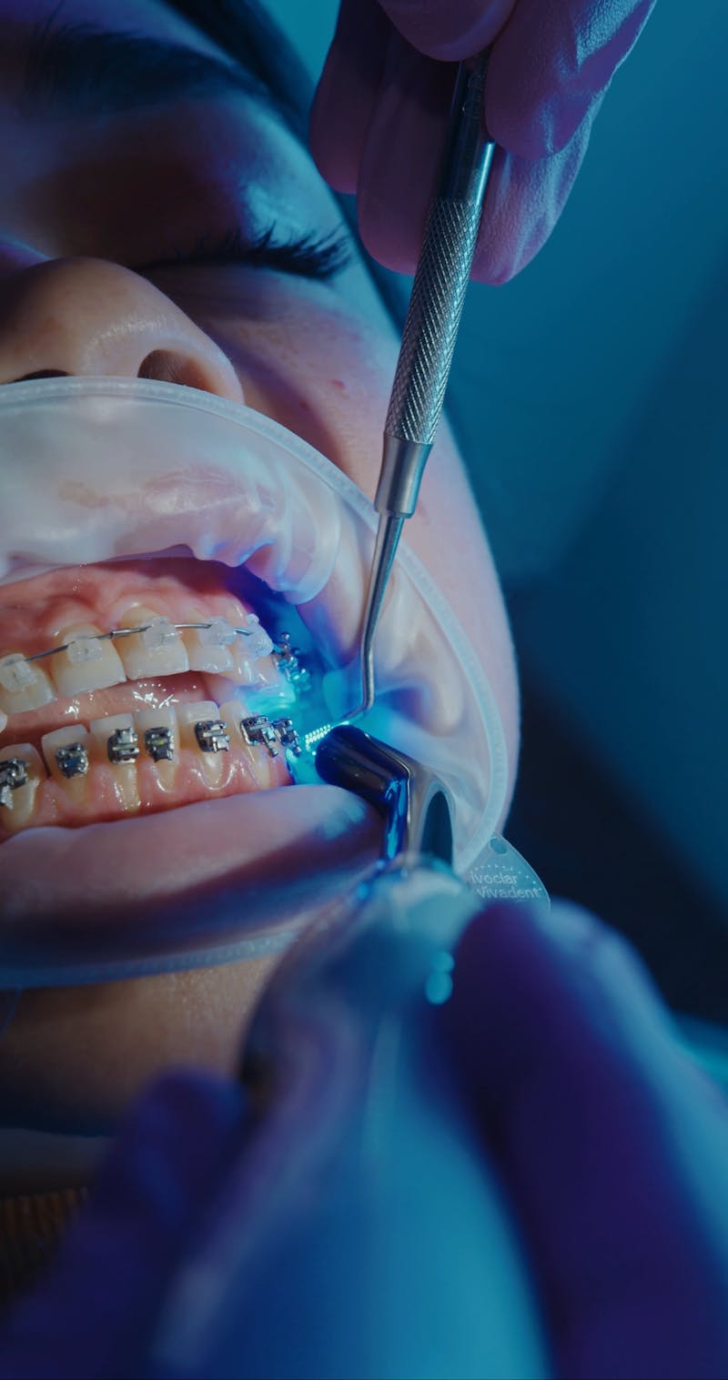 Braces Videos, Download The BEST Free 4k Stock Video Footage & Braces ...