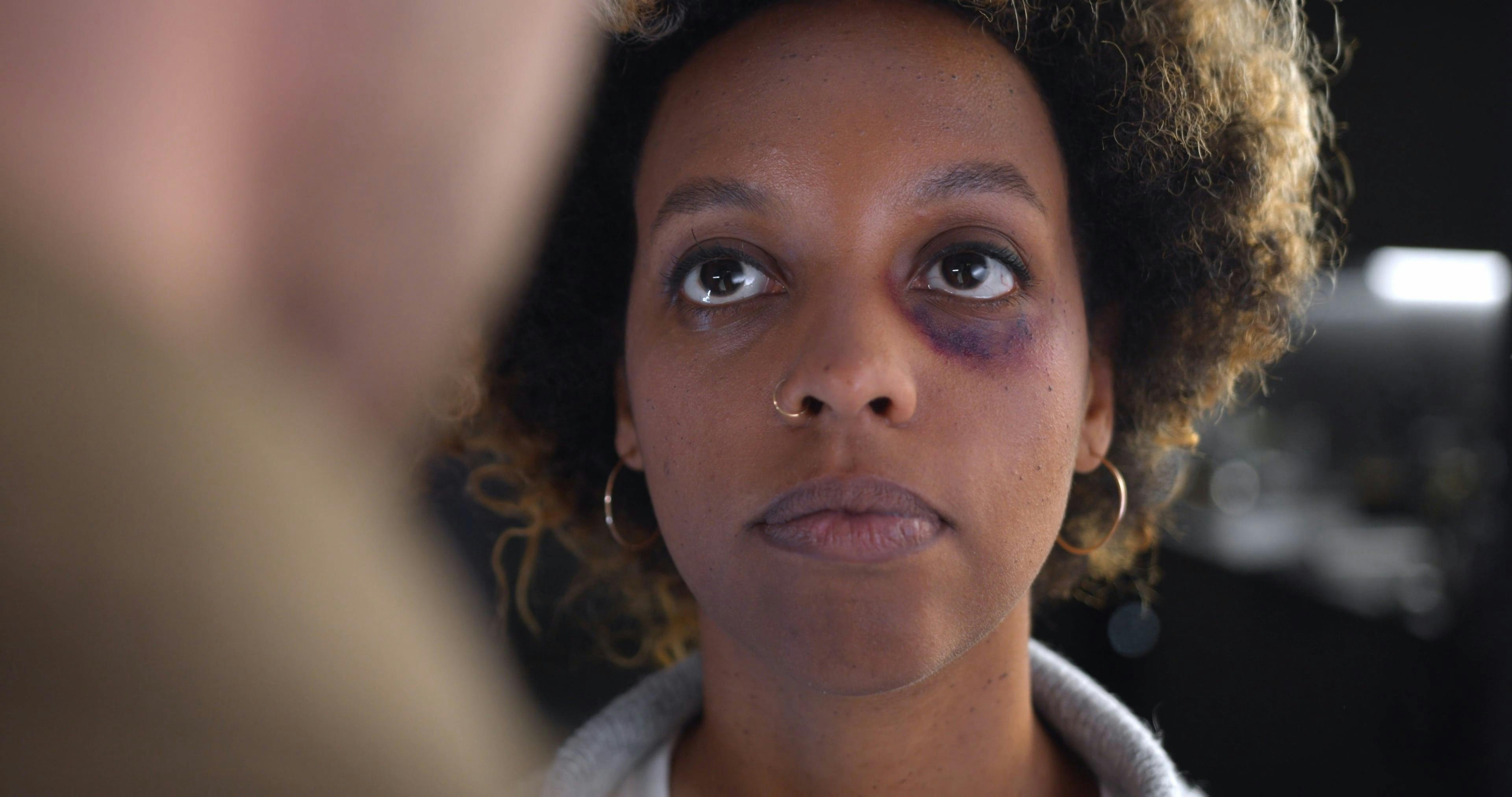 Woman With a Bruise in her Face Free Stock Video Footage, Royalty-Free ...