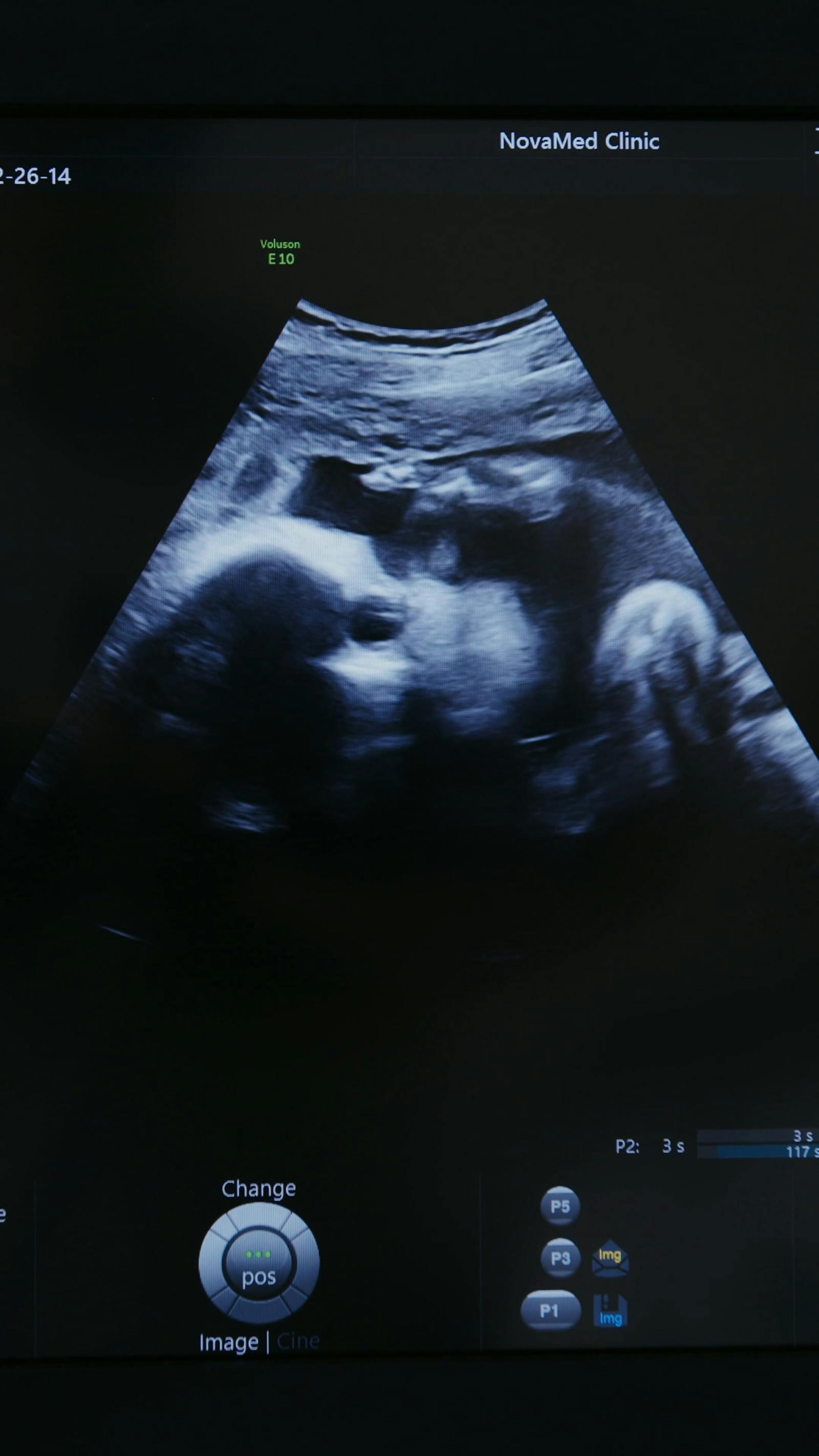 Fetus Videos, Download The BEST Free 4k Stock Video Footage & Fetus HD ...