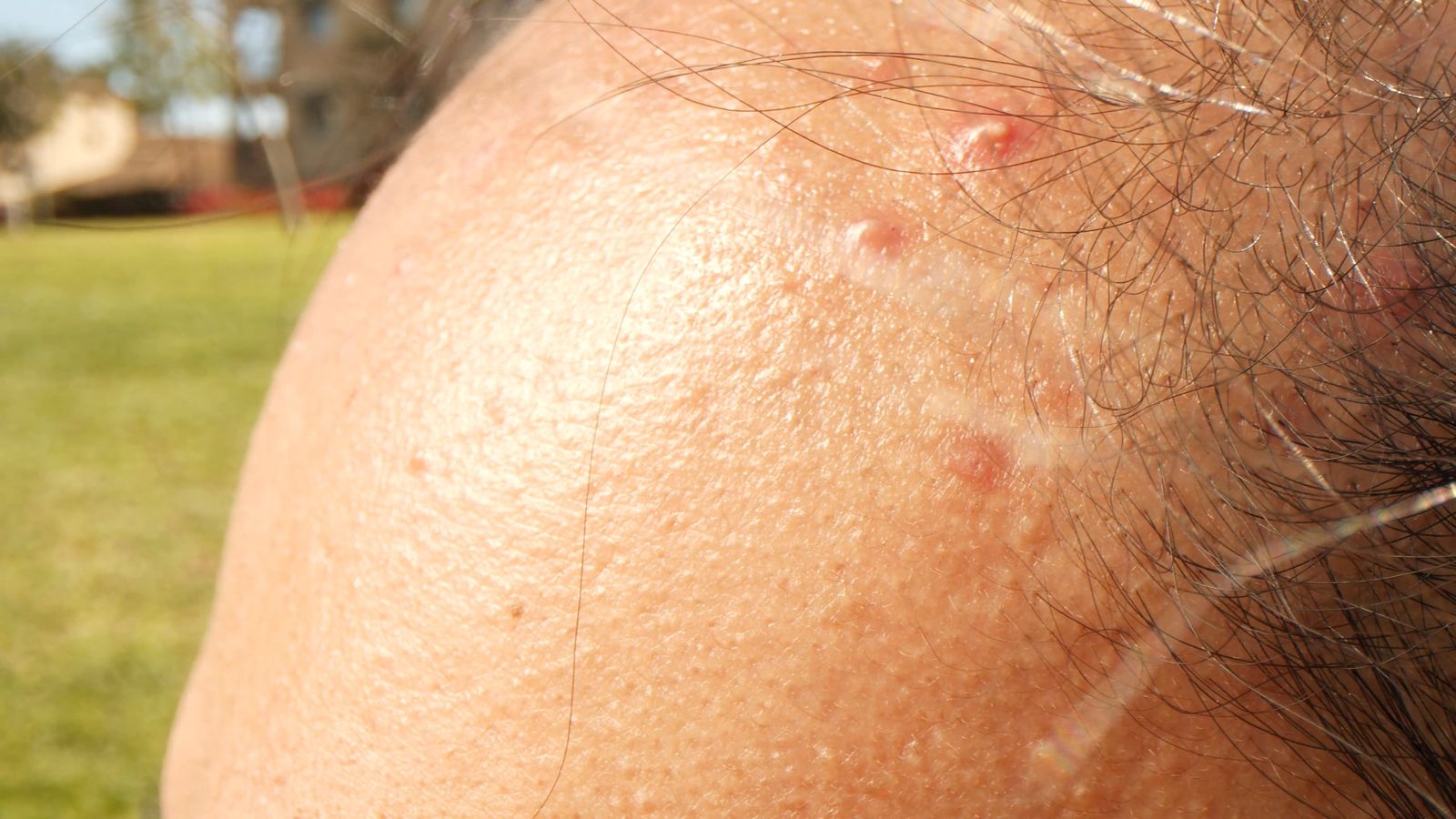 Acne And Pimples Videos, Download The BEST Free 4k Stock Video Footage ...