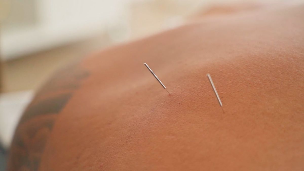 Acupuncture Videos, Download The BEST Free 4k Stock Video Footage ...