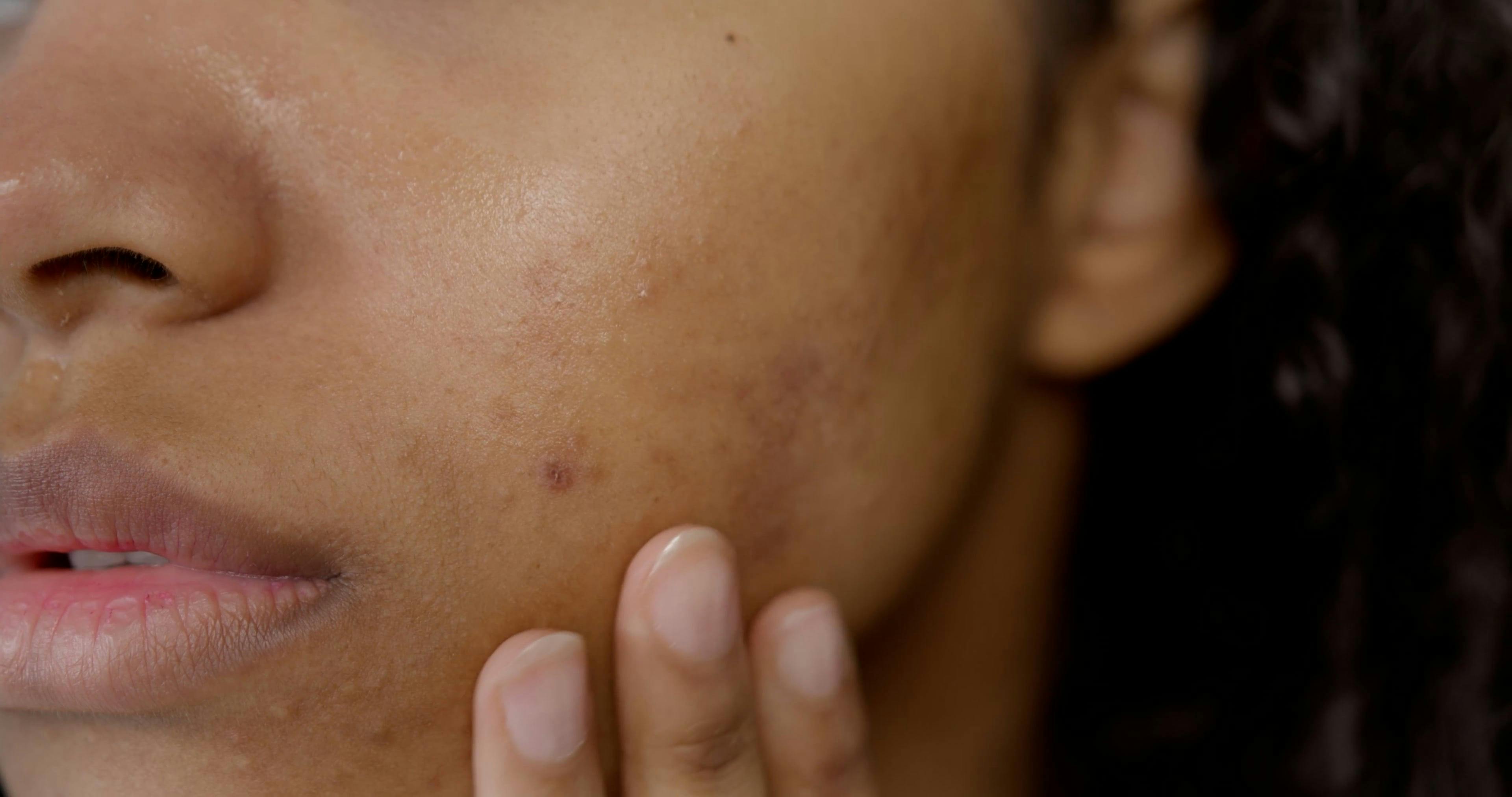 Acne Face Videos, Download The BEST Free 4k Stock Video Footage & Acne ...