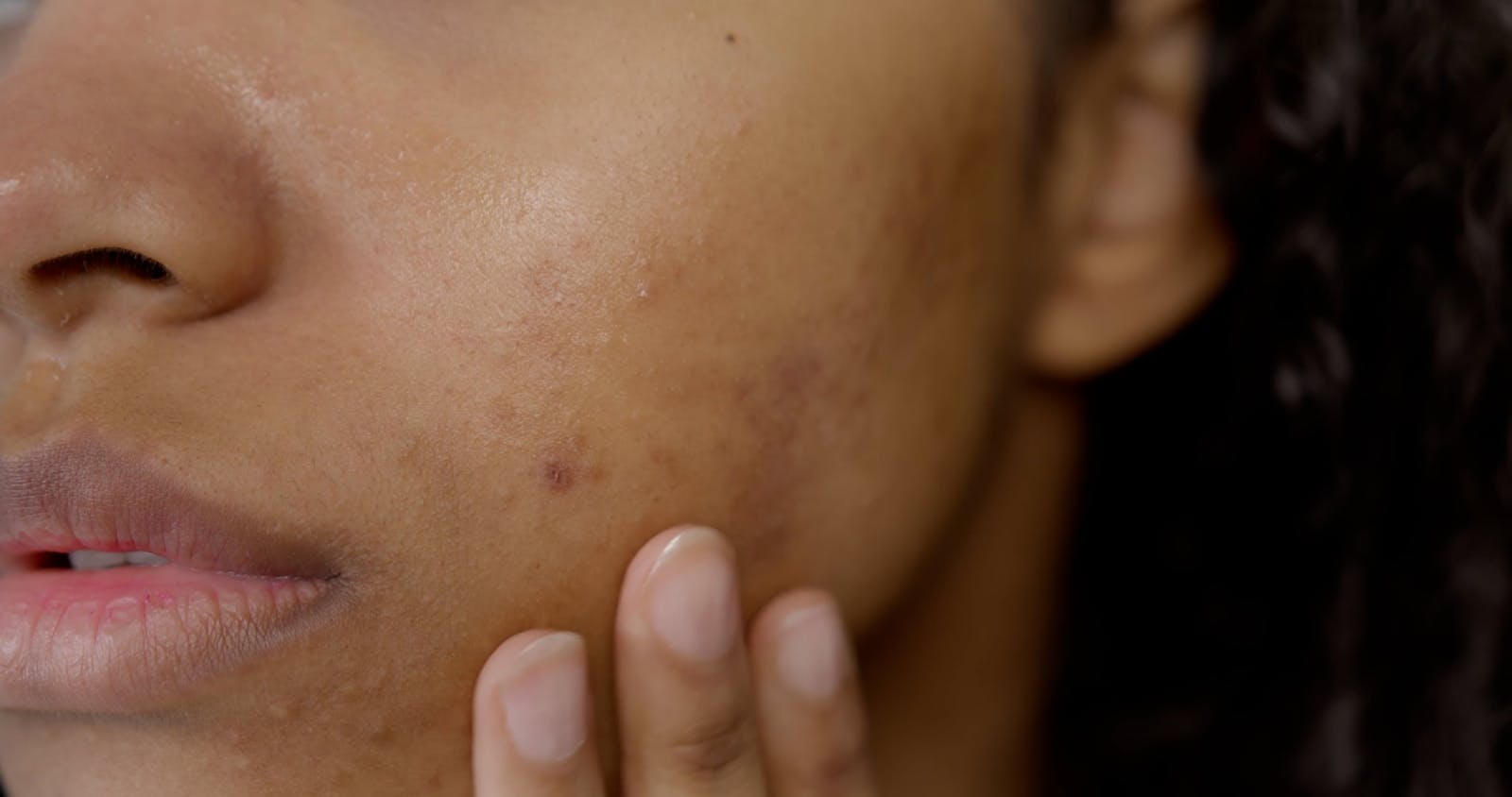 Face Acne Videos, Download The BEST Free 4k Stock Video Footage & Face ...