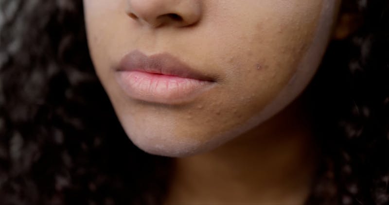 Pimple Face Videos, Download The BEST Free 4k Stock Video Footage ...